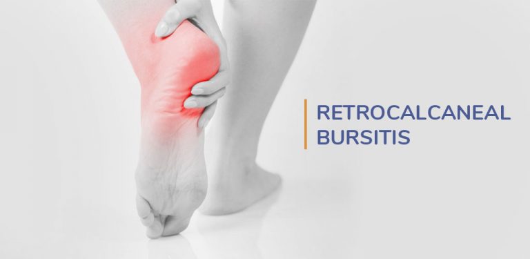 Retrocalcaneal bursitis - Physioline