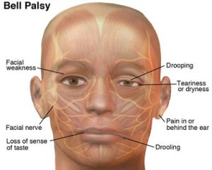 Facial Palsy / Bell’s Palsy Avoid Synkinesis - Physioline